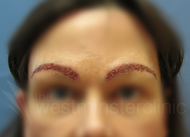 Master_eyebrows_During - Westminster Clinic